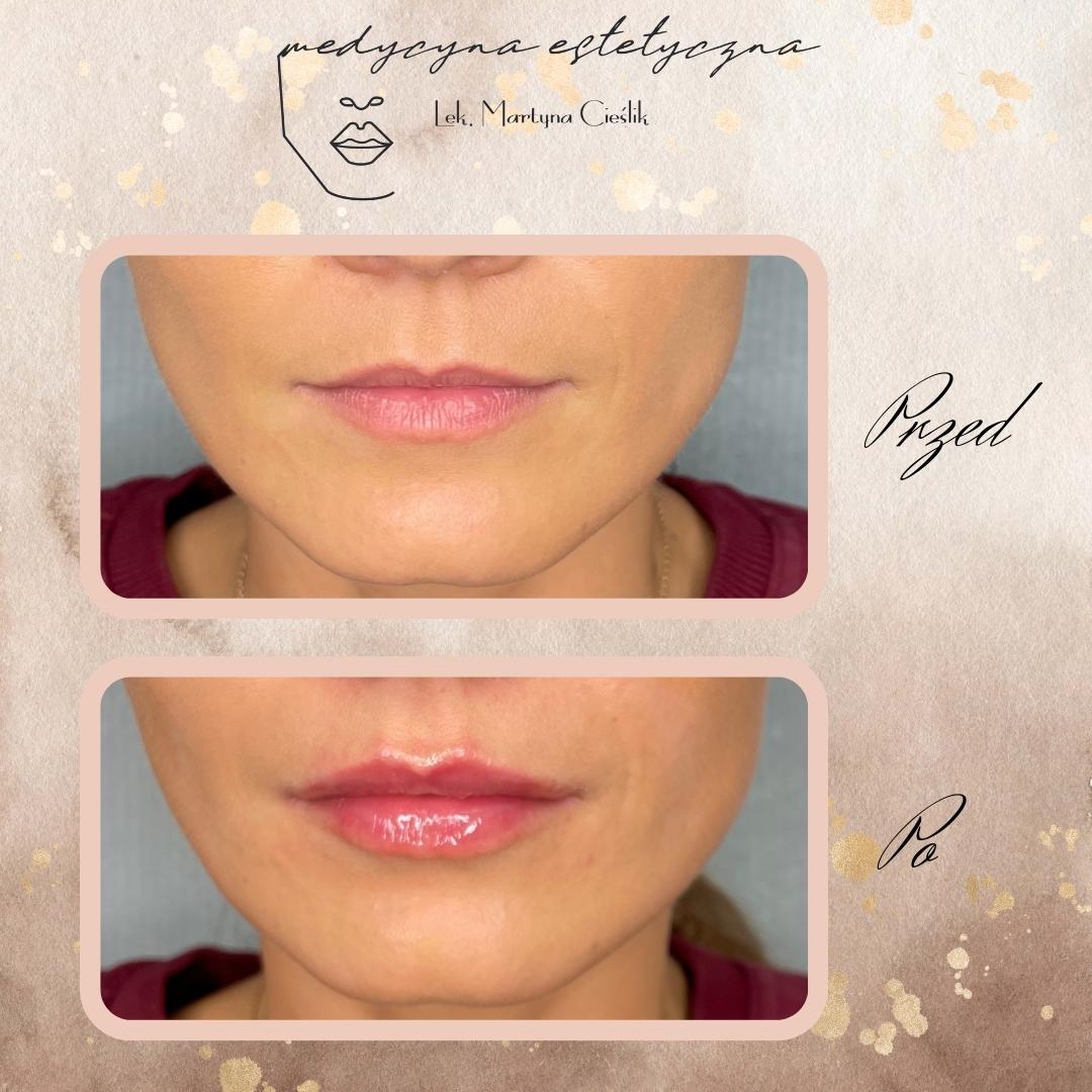 Modelowanie ust - Medycyna Estetyczna lekarz Martyna Cieślik